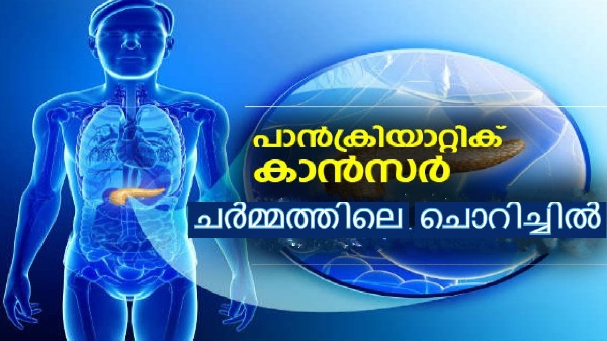 ഉറക്കം നഷ്ടപ്പെടുത്തുന്ന ചൊറിച്ചില്‍ :പാന്‍ക്രിയാറ്റിക് ക്യാന്‍സര് ...